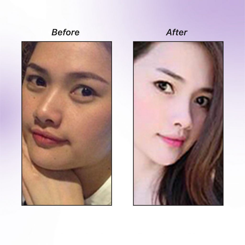 Relumins Advance White 1650mg 15x Glutathione Complex – New version ...